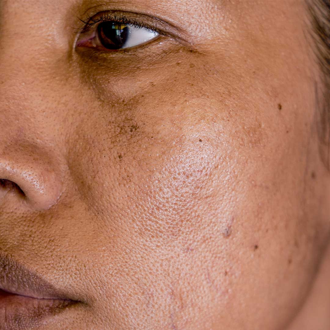 Pigmentation Disorders | Central Alberta Dermatology Clinic