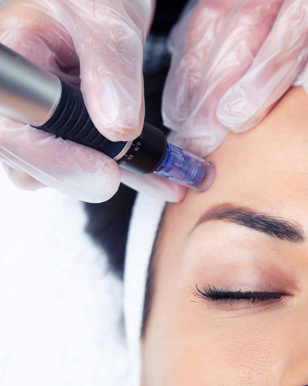 Microneedling in Red Deer | Central Alberta Dermatology Clinic