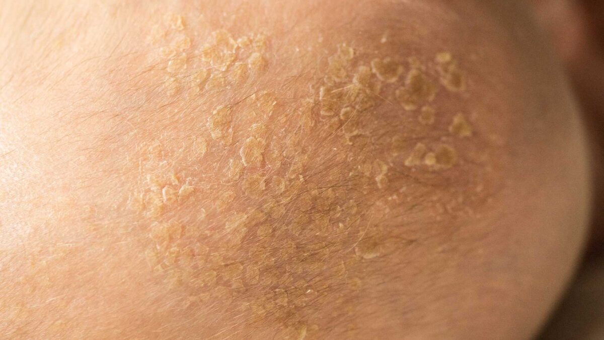 Psoriasis Treatment | Central Alberta Dermatology Clinic