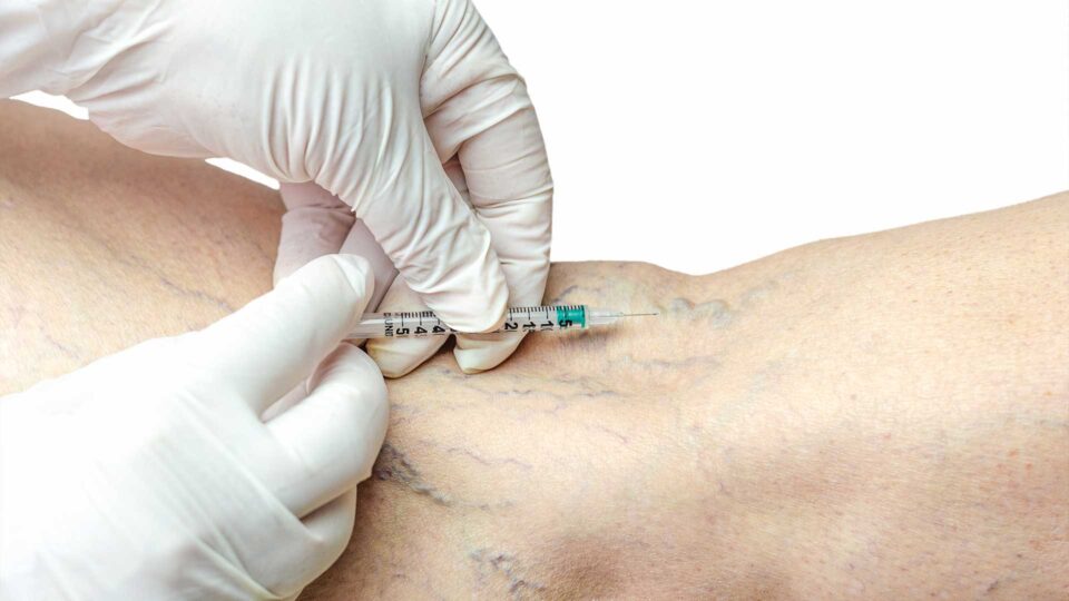 Sclerotherapy in Red Deer | Spider Vein and Varicose Veins Treatment